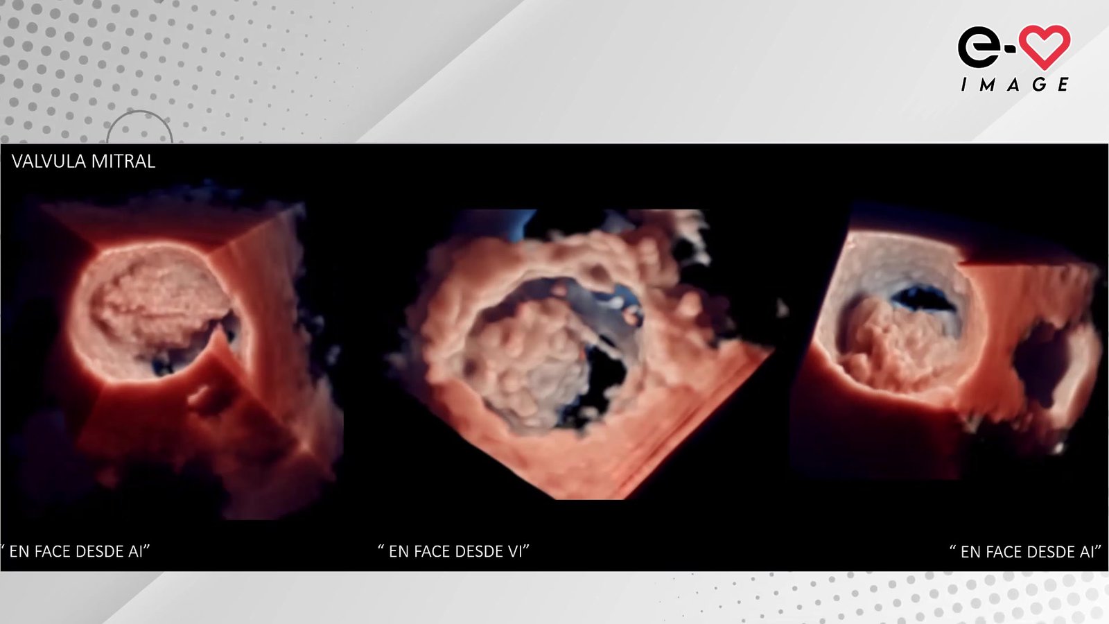 Entrevista – Extrasistolia ventricular frecuente - e-cardioimage